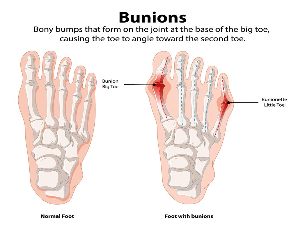 Bunions: Symptoms, Causes, & Treatment - Florida Foot and Ankle Clinic